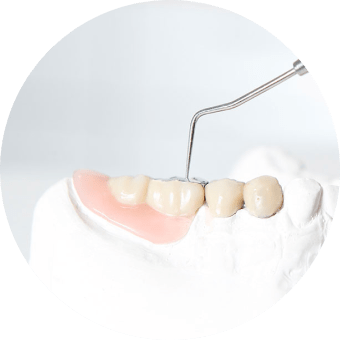 Les couronnes & les Inlay - Onlay | Dr Tonnot | Chirurgien-dentiste Seltz